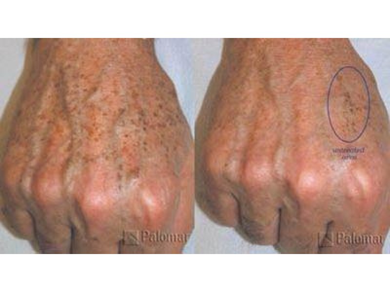 Get Rid of Those Aging Brown Age Spots - Castro Valley, CA Patch