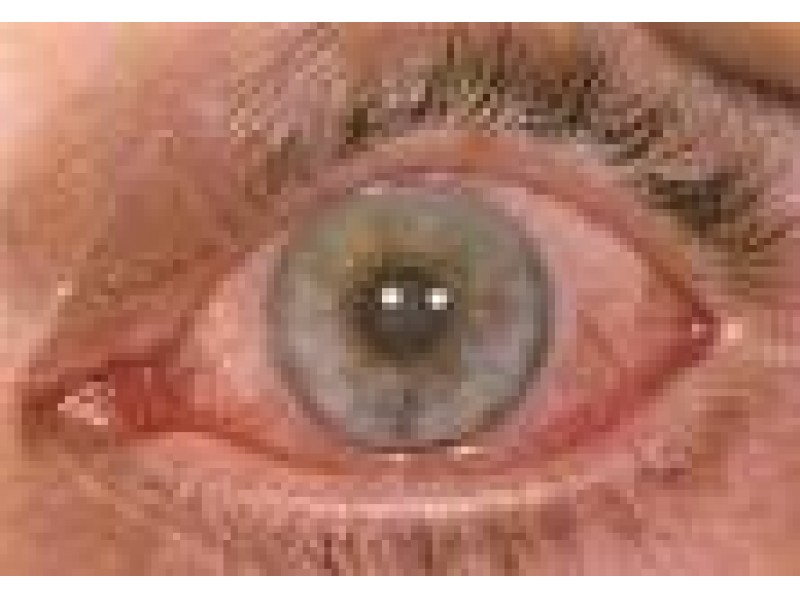 Free download Dry Patch Eye Contact Lenses programs - loverprogs